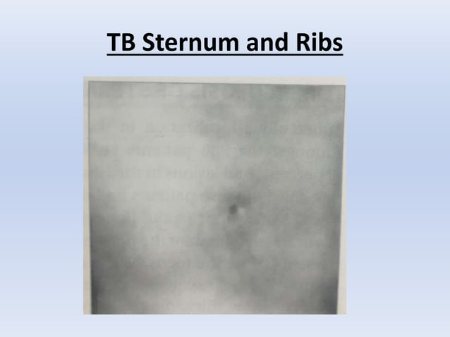 Tuberculosis of bone and joints | PPTX