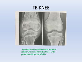 Tuberculosis of bone and joints | PPT