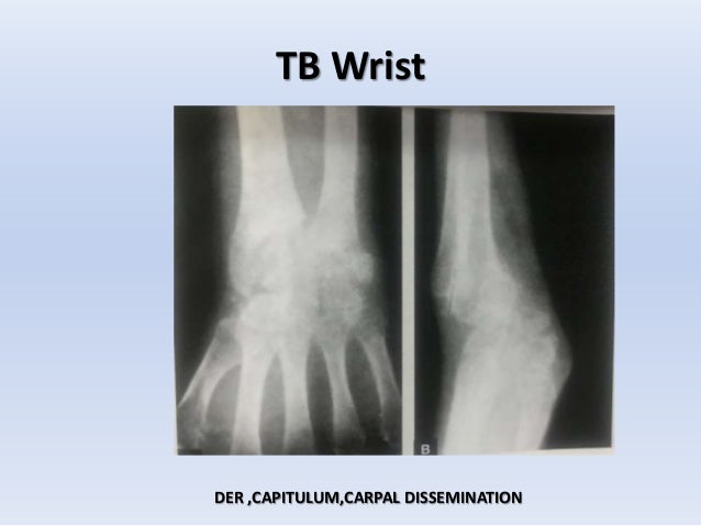 Tuberculosis of bone and joints