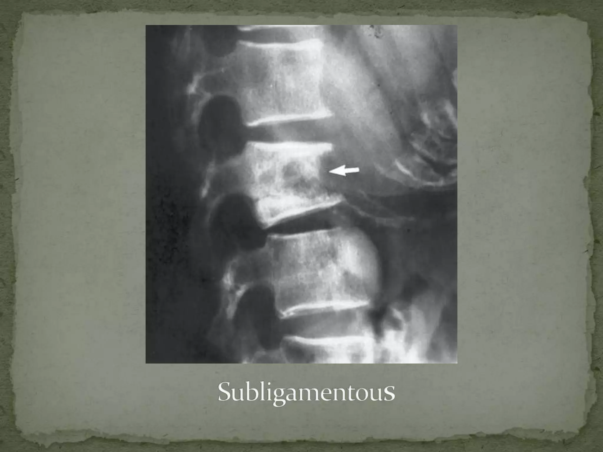 Tuberculosis of bones and joints | PPTX