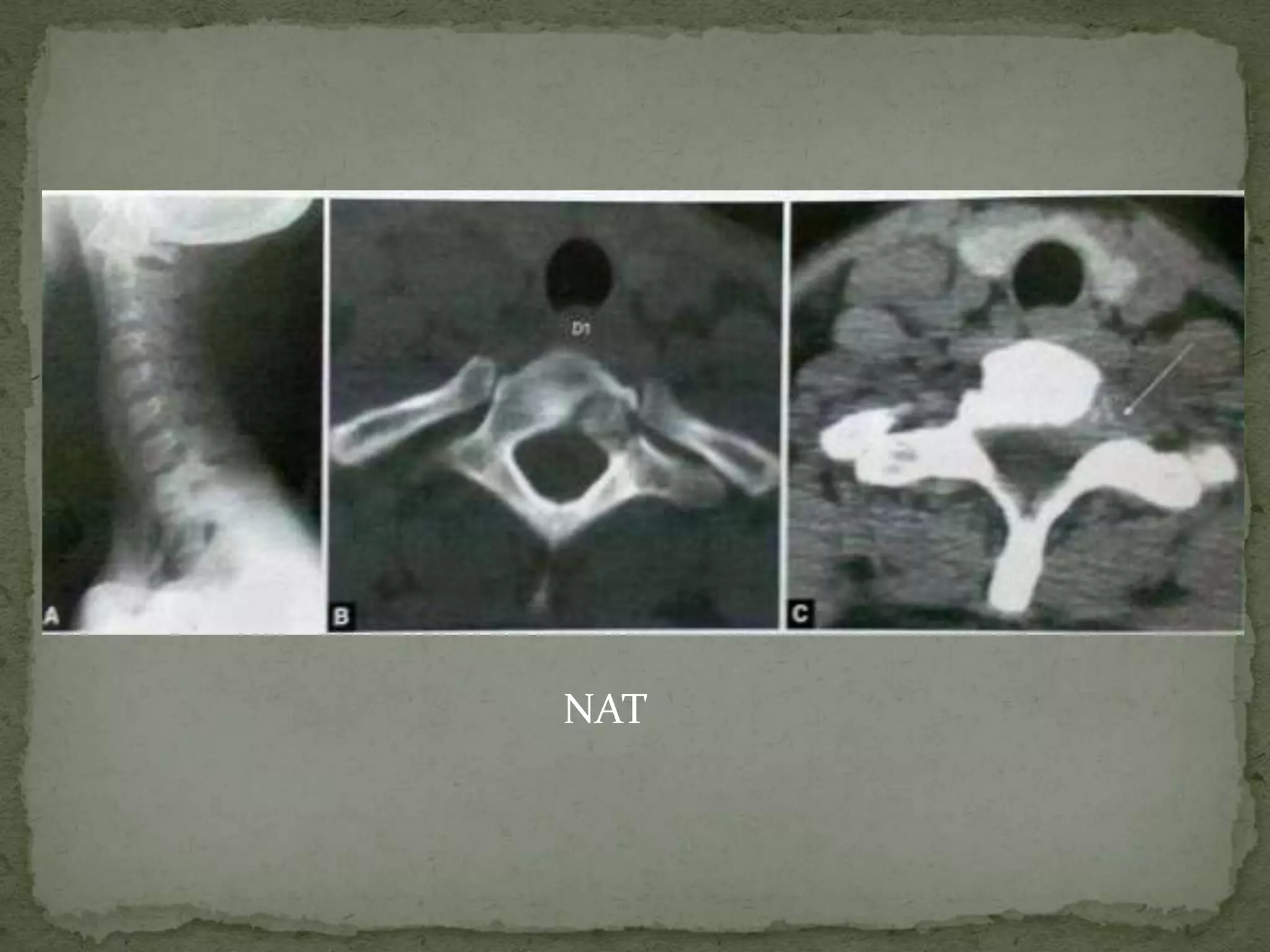 Tuberculosis of bones and joints | PPTX