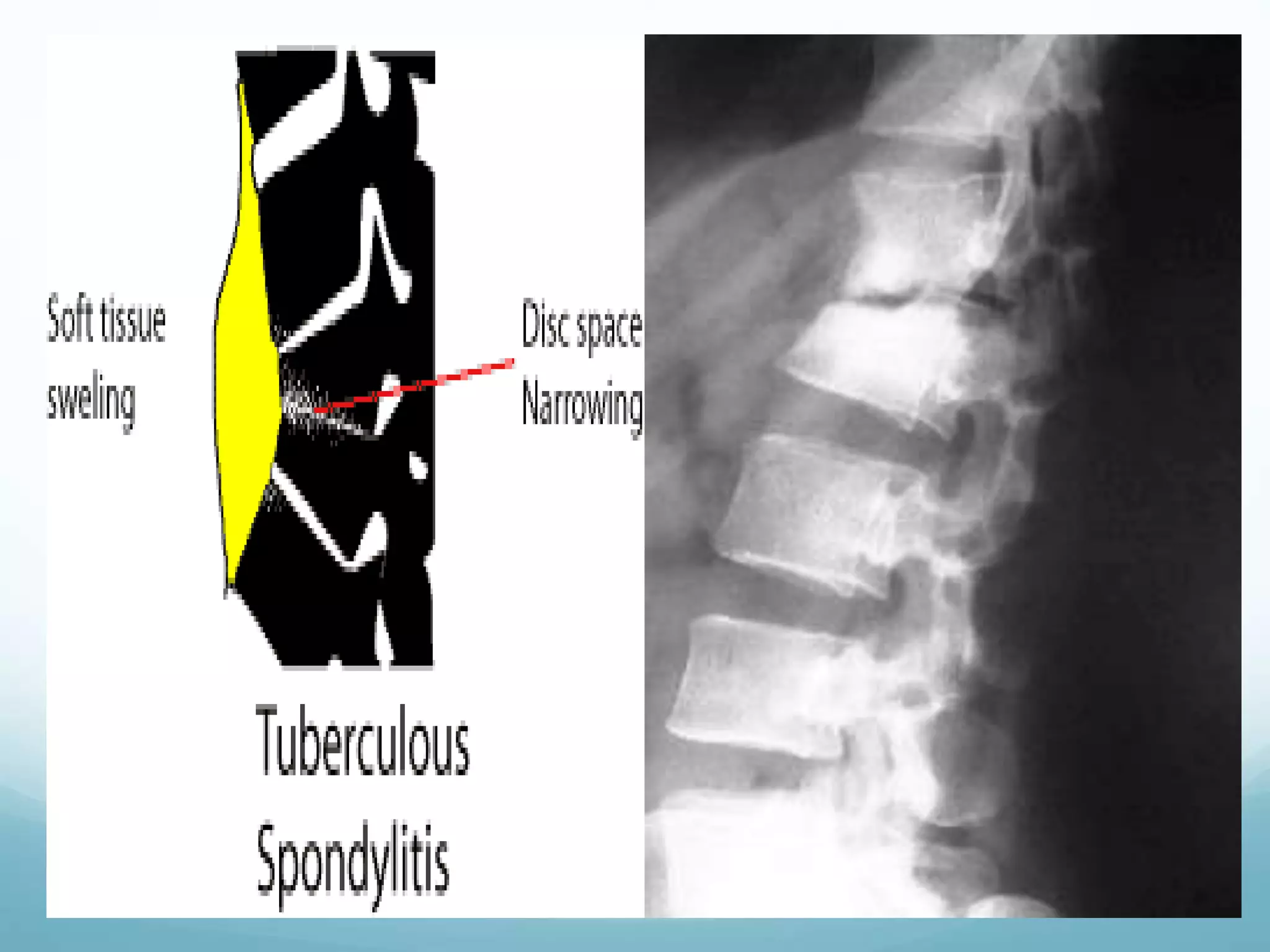 Tuberculosis of bones and joints | PPTX