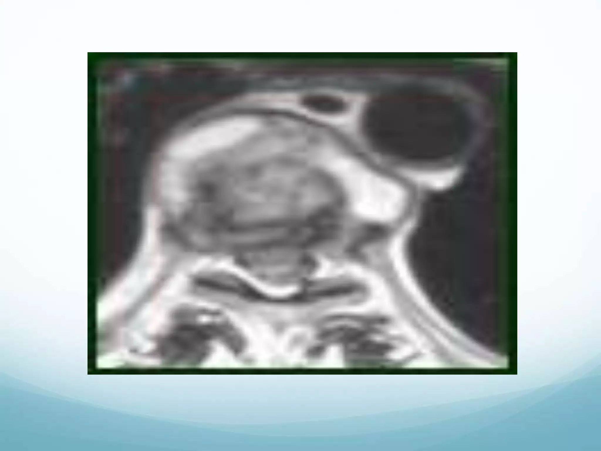 Tuberculosis of bones and joints | PPTX
