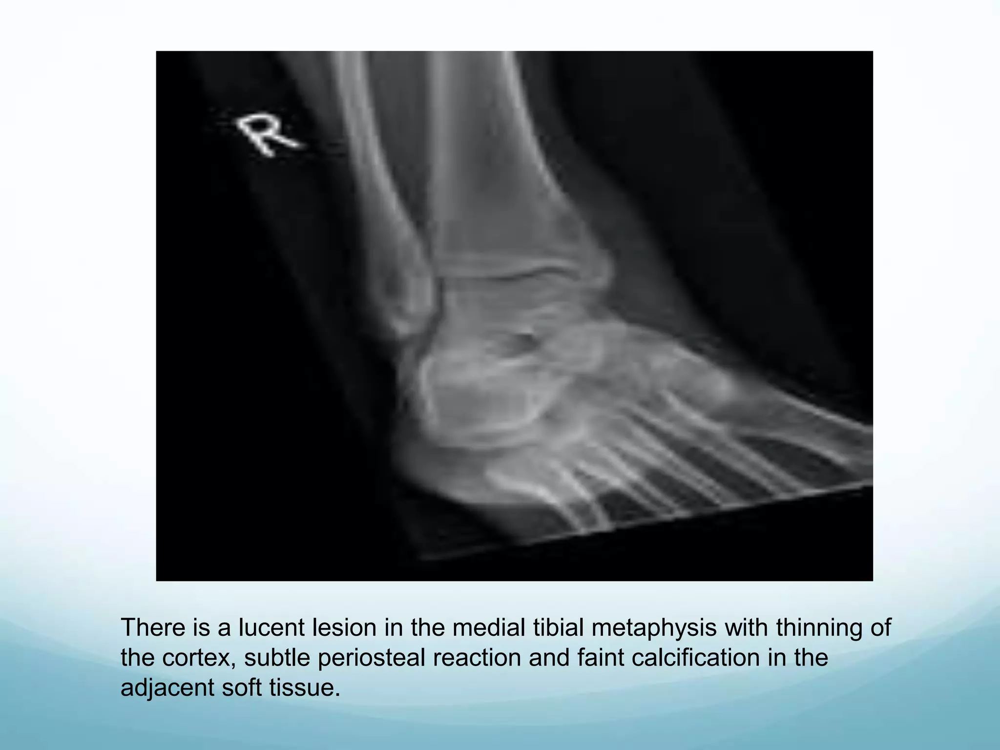 Tuberculosis of bones and joints | PPTX