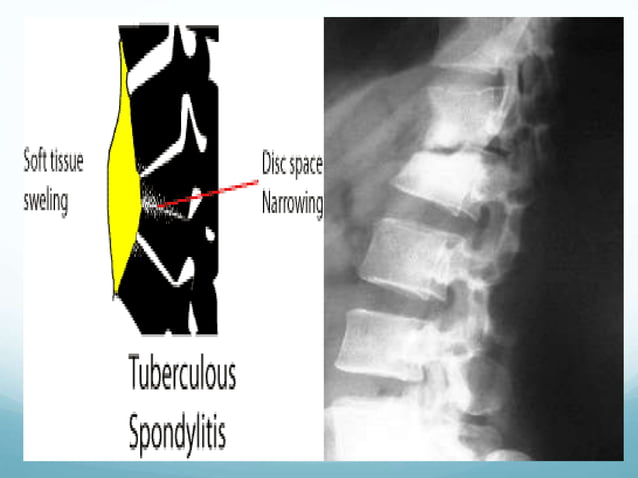 Tuberculosis of bones and joints | PPT