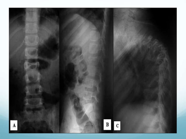 Tuberculosis of bones and joints | PPTX