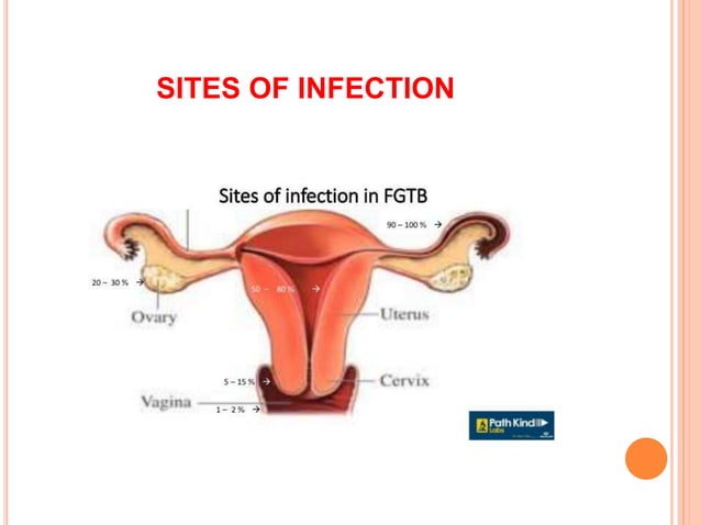 Tuberculosis of genital tract presentation | PPTX | Infertility | Reproductive Health