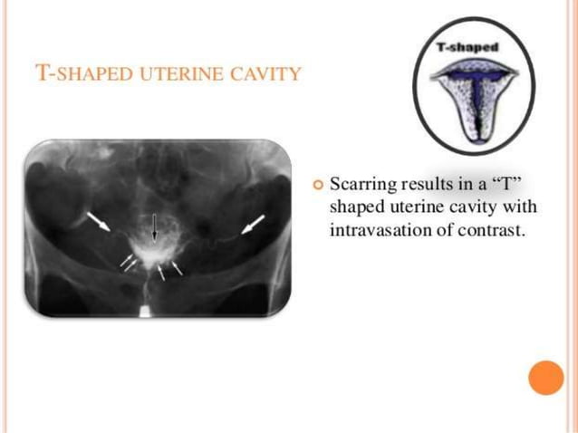 Tuberculosis of genital tract presentation | PPTX | Infertility ...