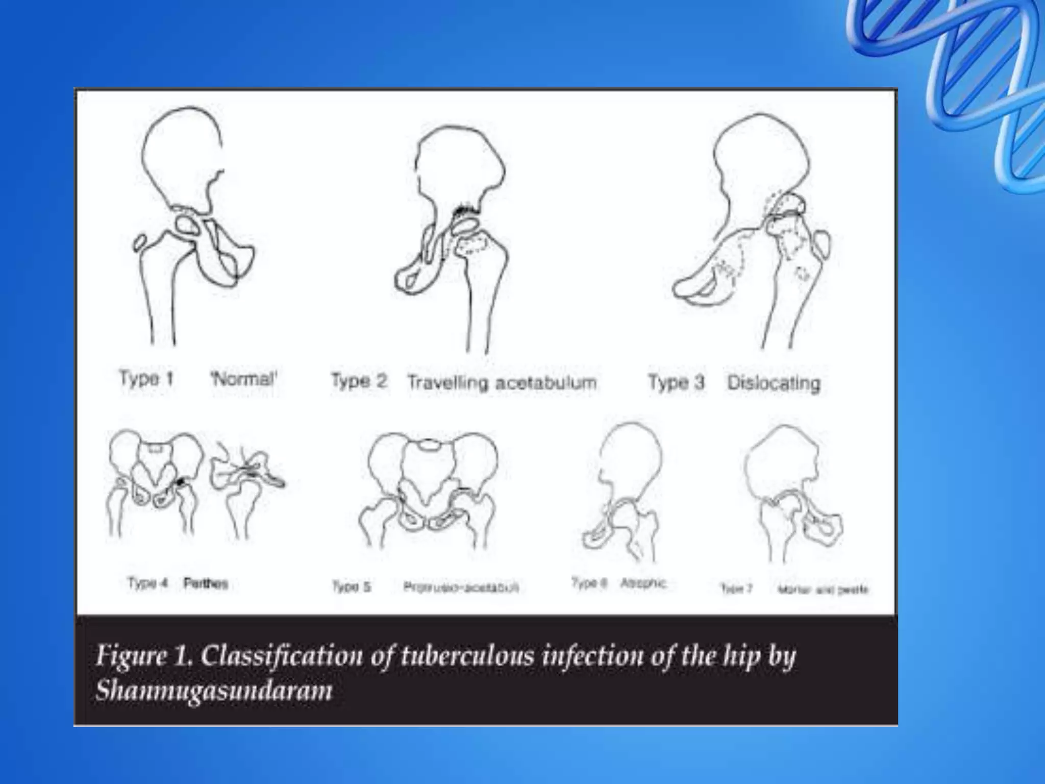 Tuberculosis of hip | PPTX