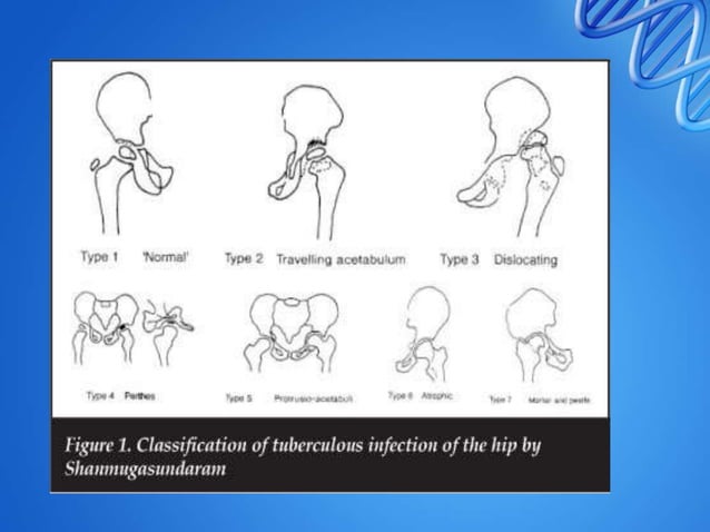 Tuberculosis of hip | PPTX