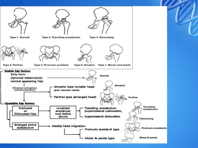 Tuberculosis of hip | PPTX