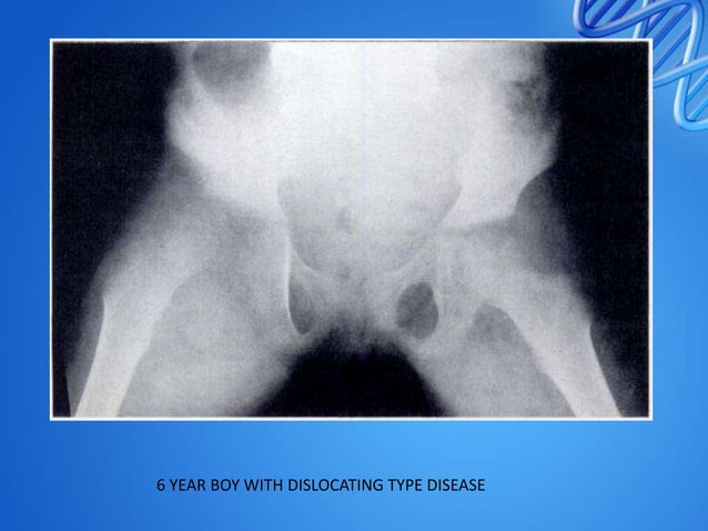Tuberculosis of hip | PPTX