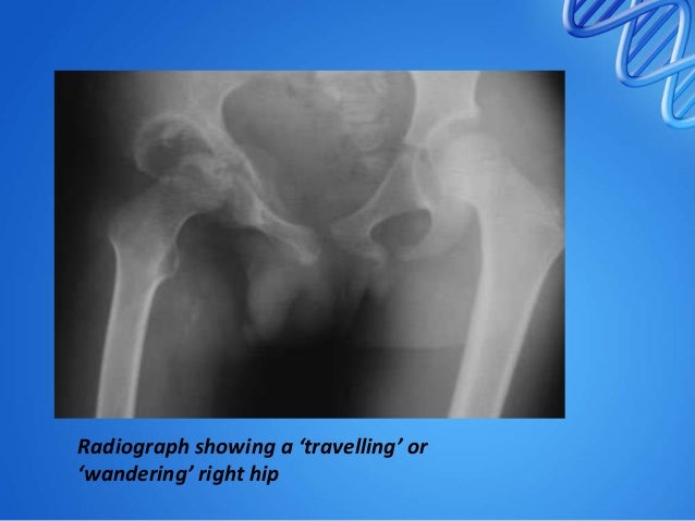 Tuberculosis of hip
