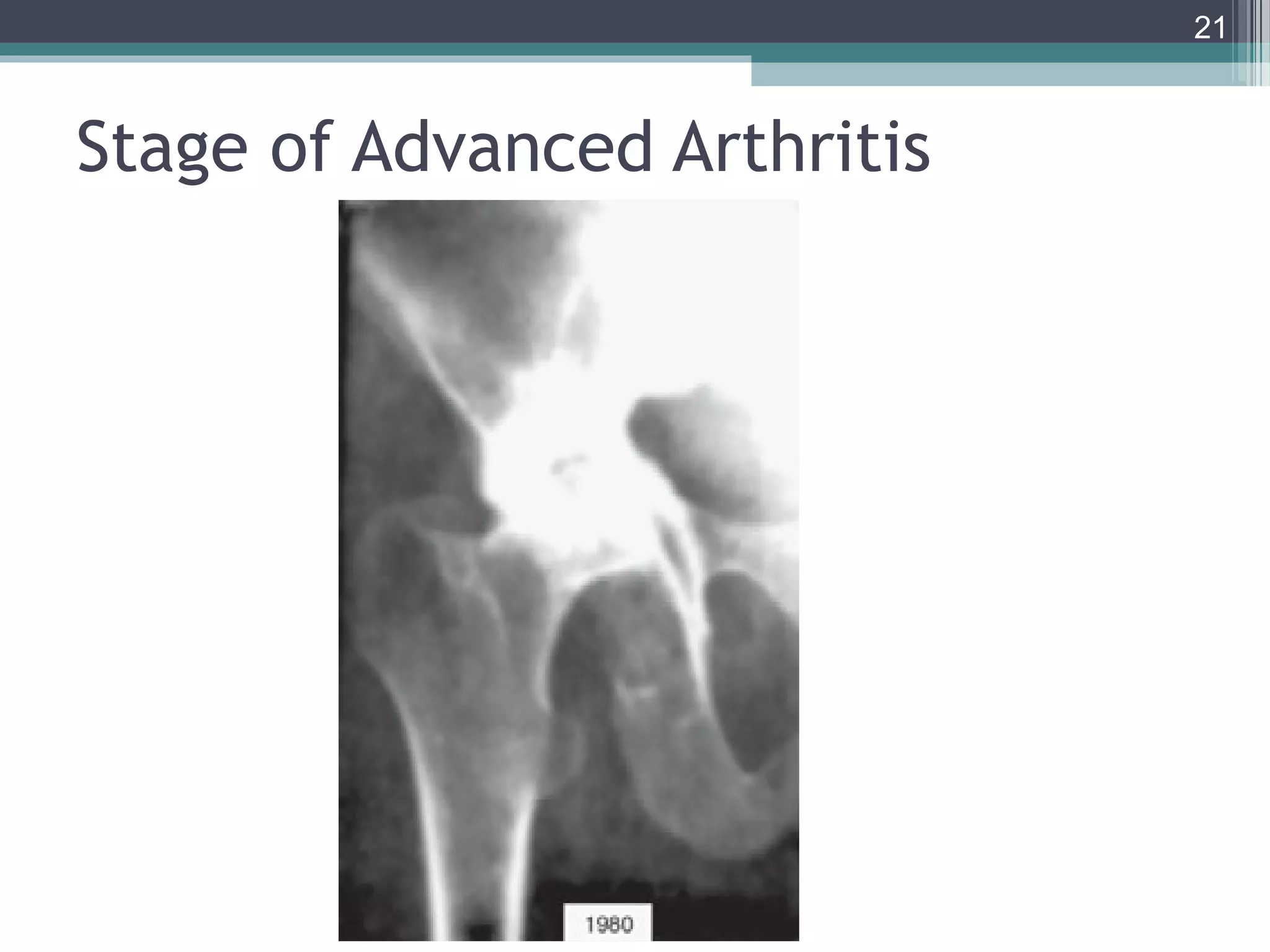 Tuberculosis of hip and knee | PPT