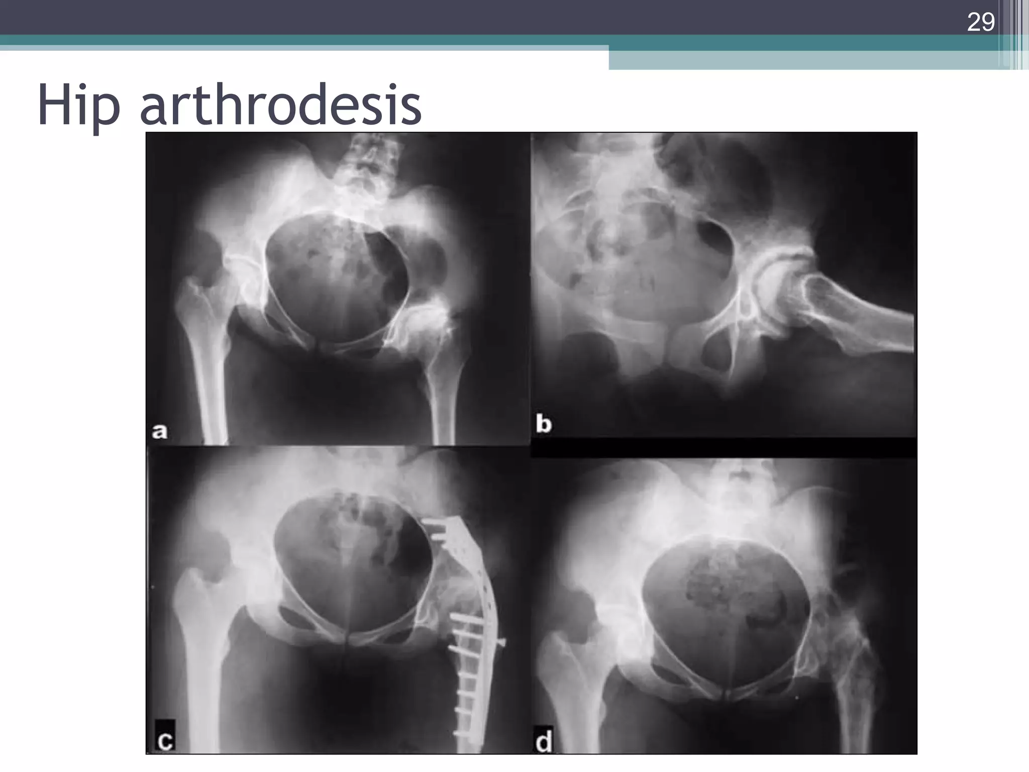 Tuberculosis of hip and knee | PPT