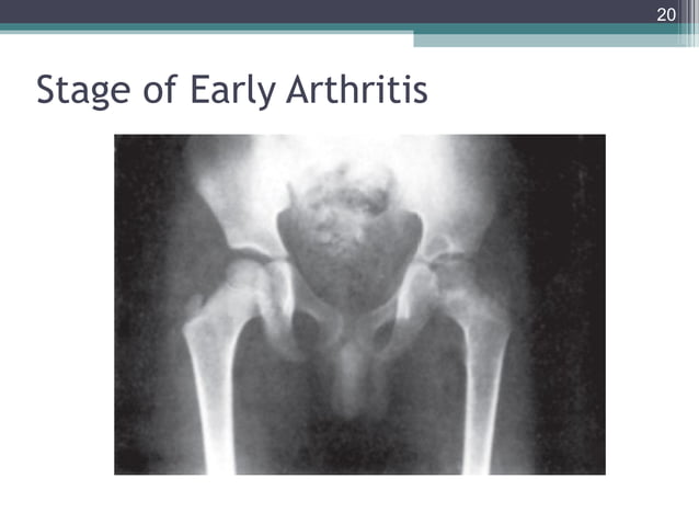 Tuberculosis of hip and knee | PPT