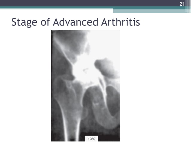 Tuberculosis of hip and knee | PPT