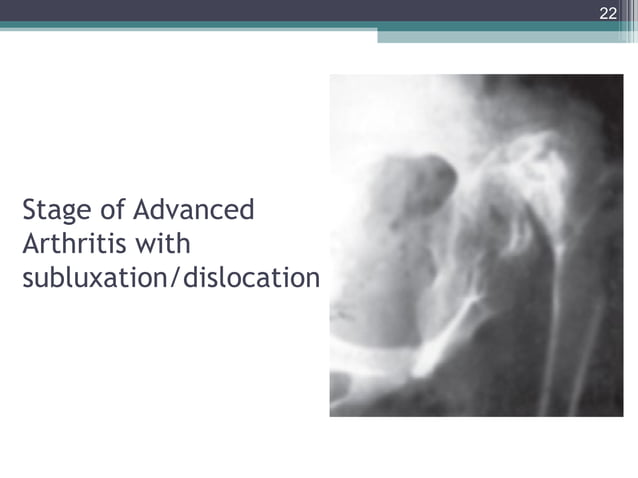 Tuberculosis of hip and knee | PPT