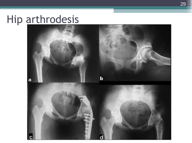 Tuberculosis of hip and knee | PPT