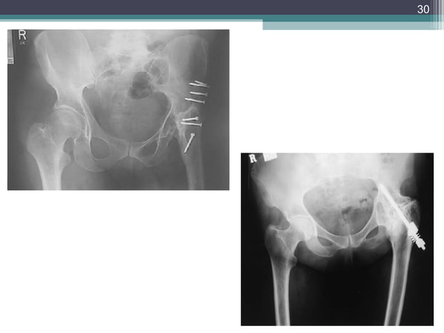 Tuberculosis of hip and knee | PPT