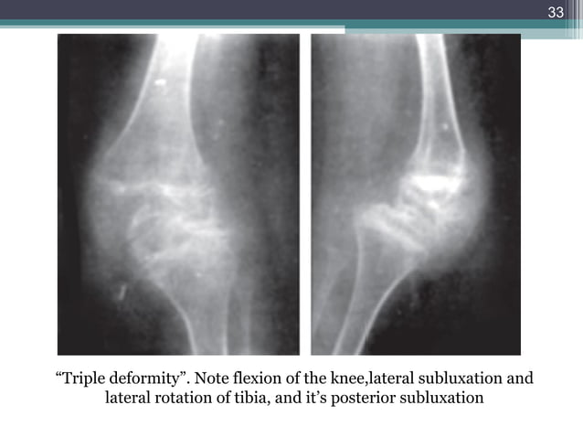 Tuberculosis of hip and knee | PPT