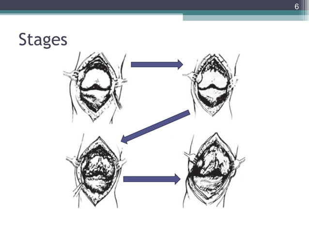 Tuberculosis of hip and knee | PPT