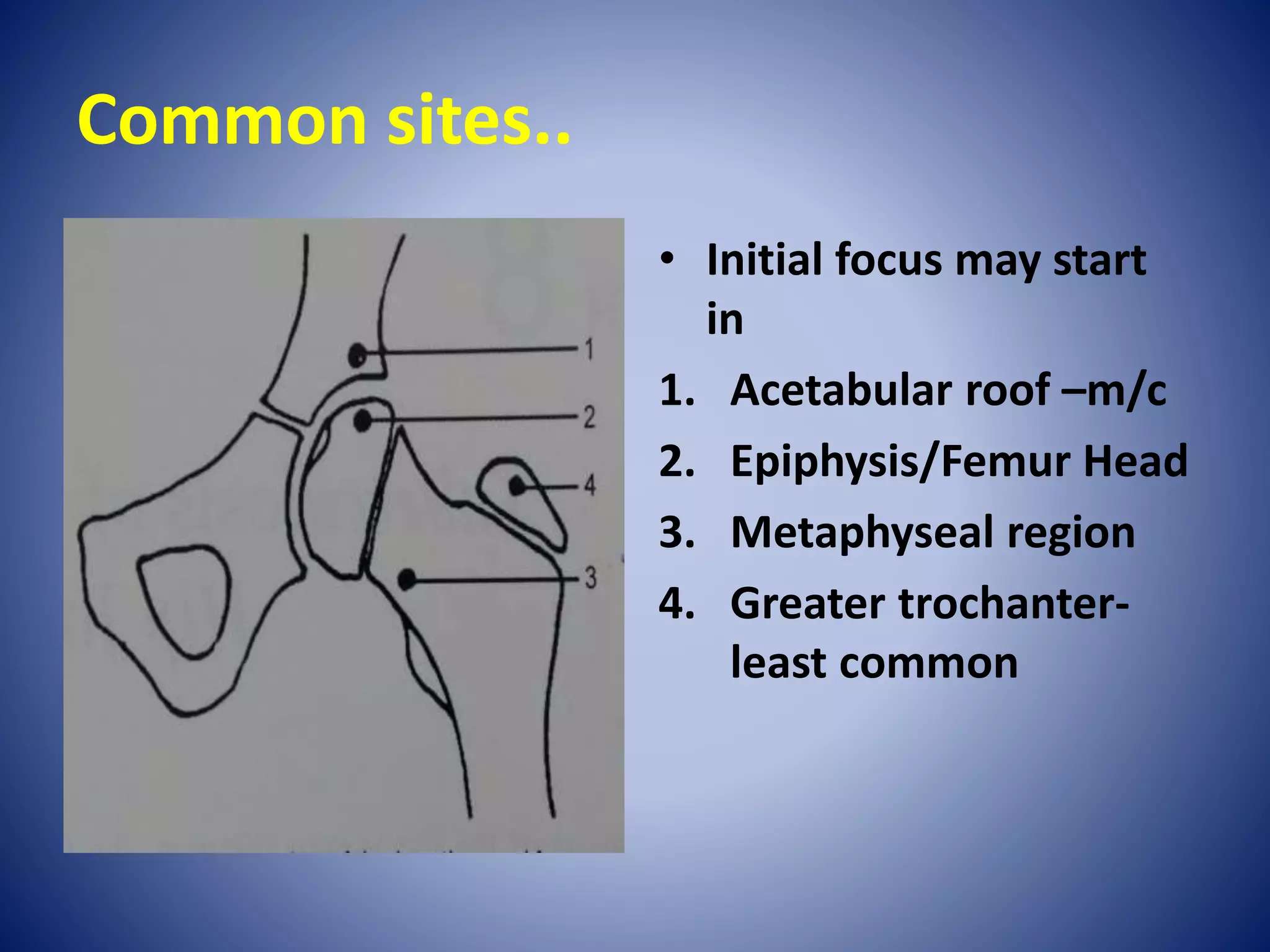 Tuberculosis of hip joint | PPTX