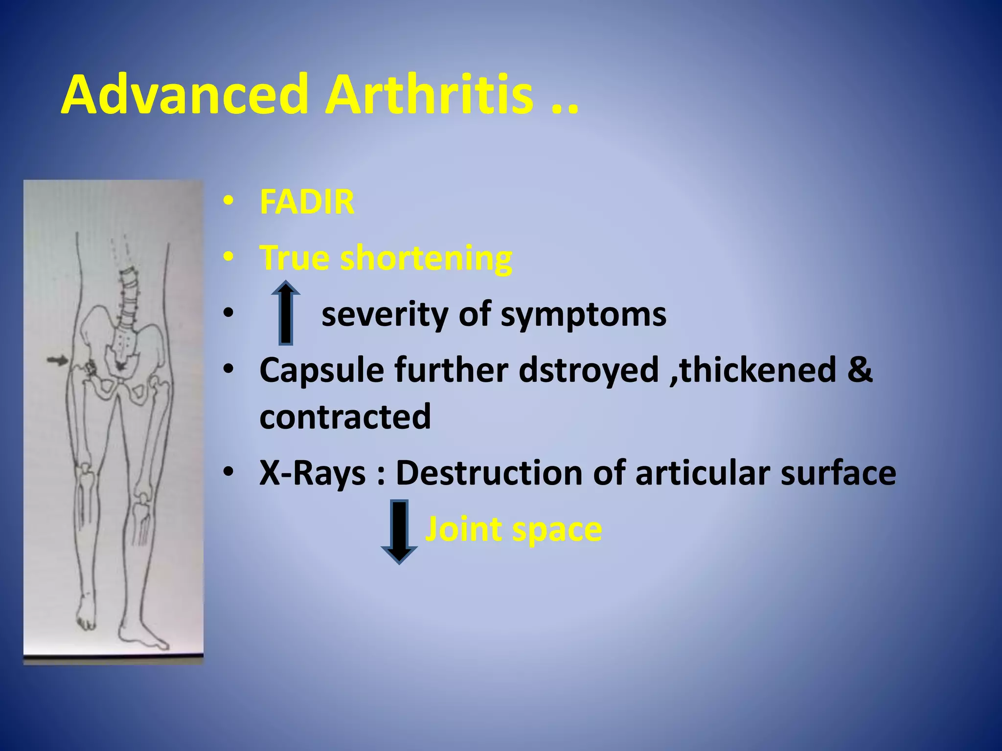 Tuberculosis of hip joint | PPTX
