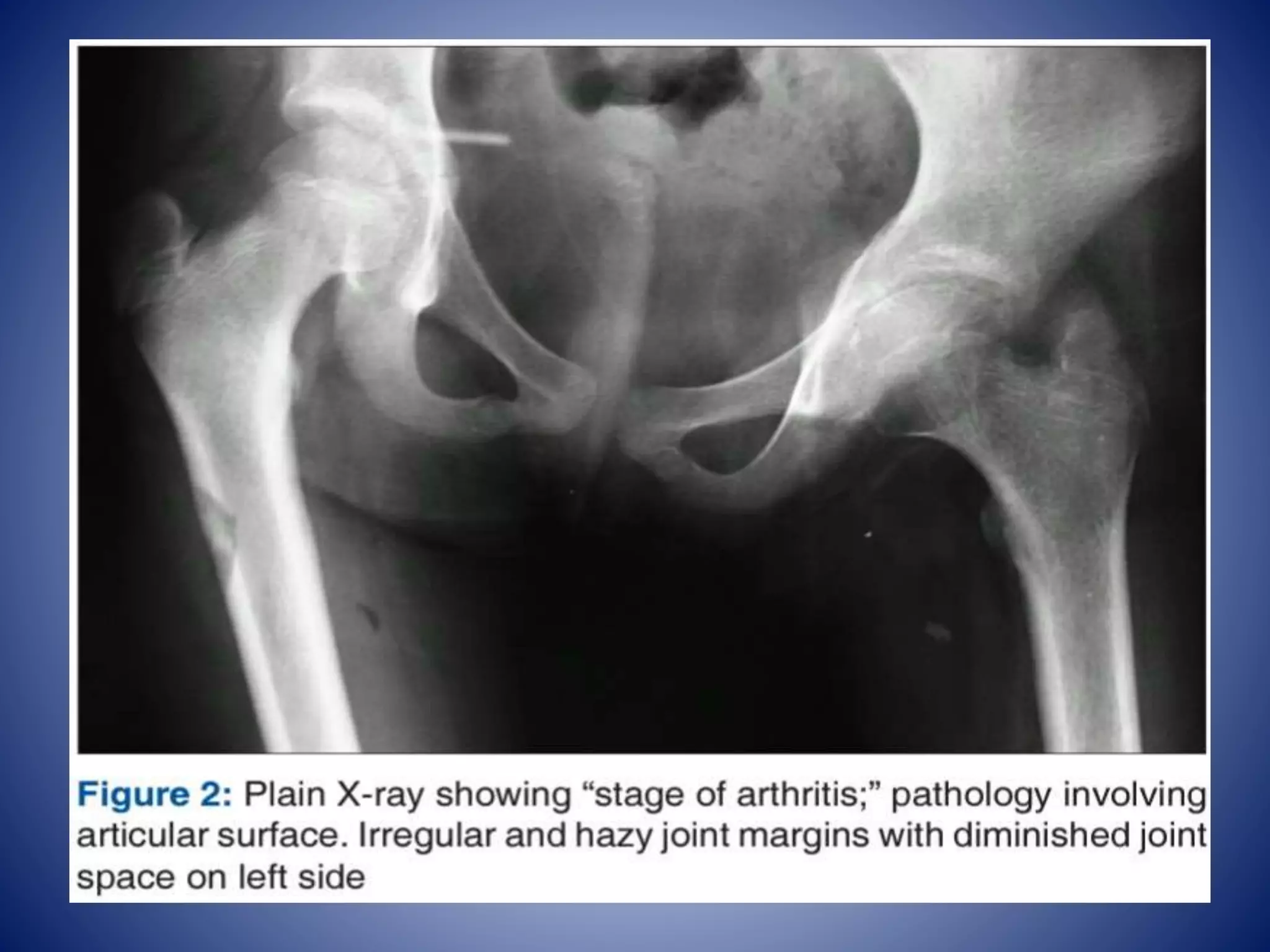 Tuberculosis of hip joint | PPTX