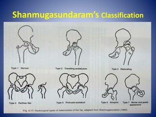 Tuberculosis of hip joint | PPTX