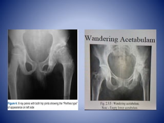 Tuberculosis of hip joint | PPTX