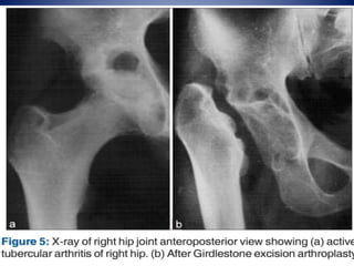 Tuberculosis of hip joint | PPTX