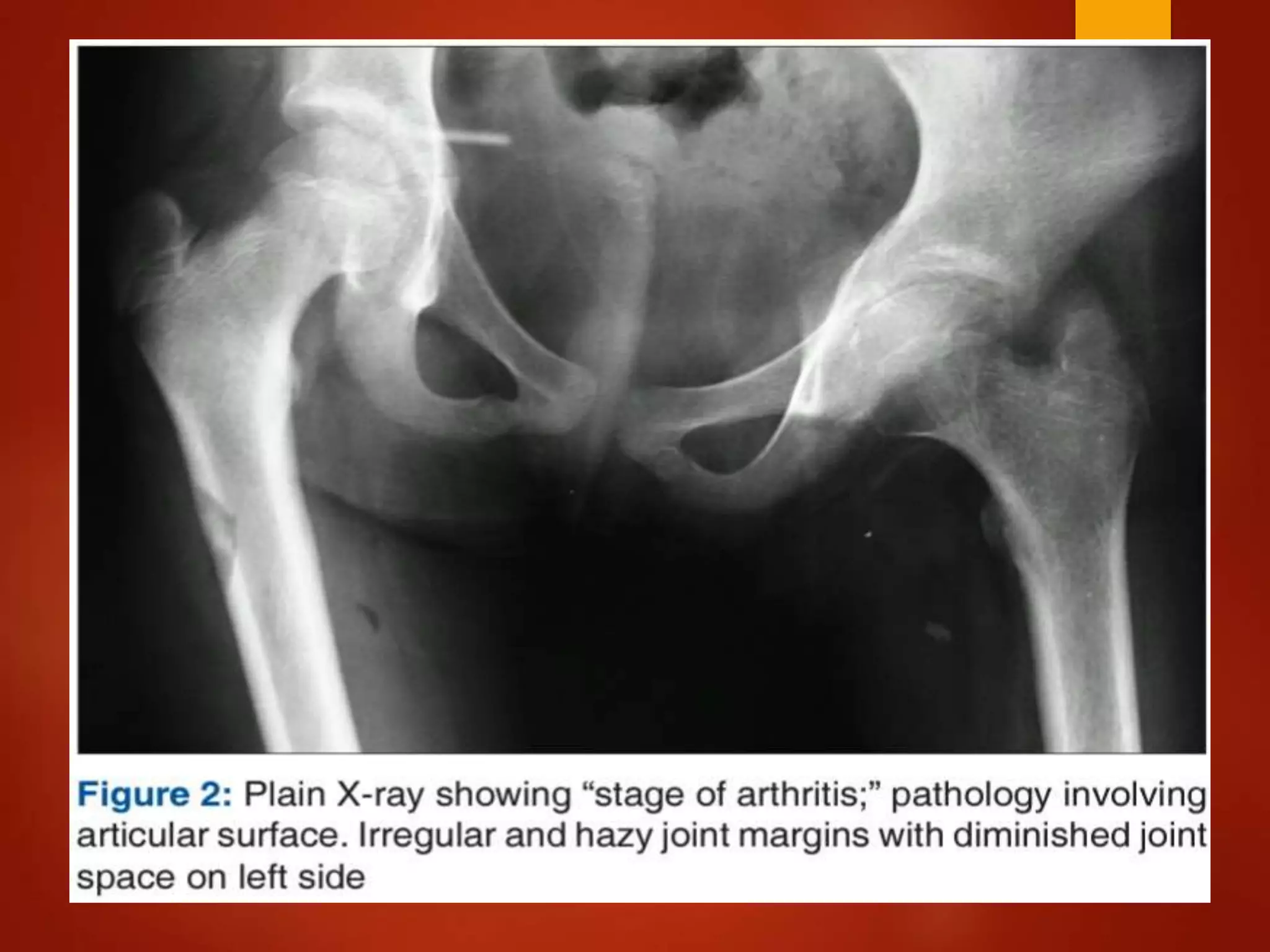 Tuberculosis of hip joint | PPT