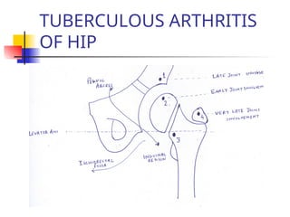 Tuberculosis_of_Hip_joint(1).pptgbggrtgrrg | PPT