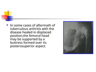 Tuberculosis_of_Hip_joint(1).pptgbggrtgrrg | PPT