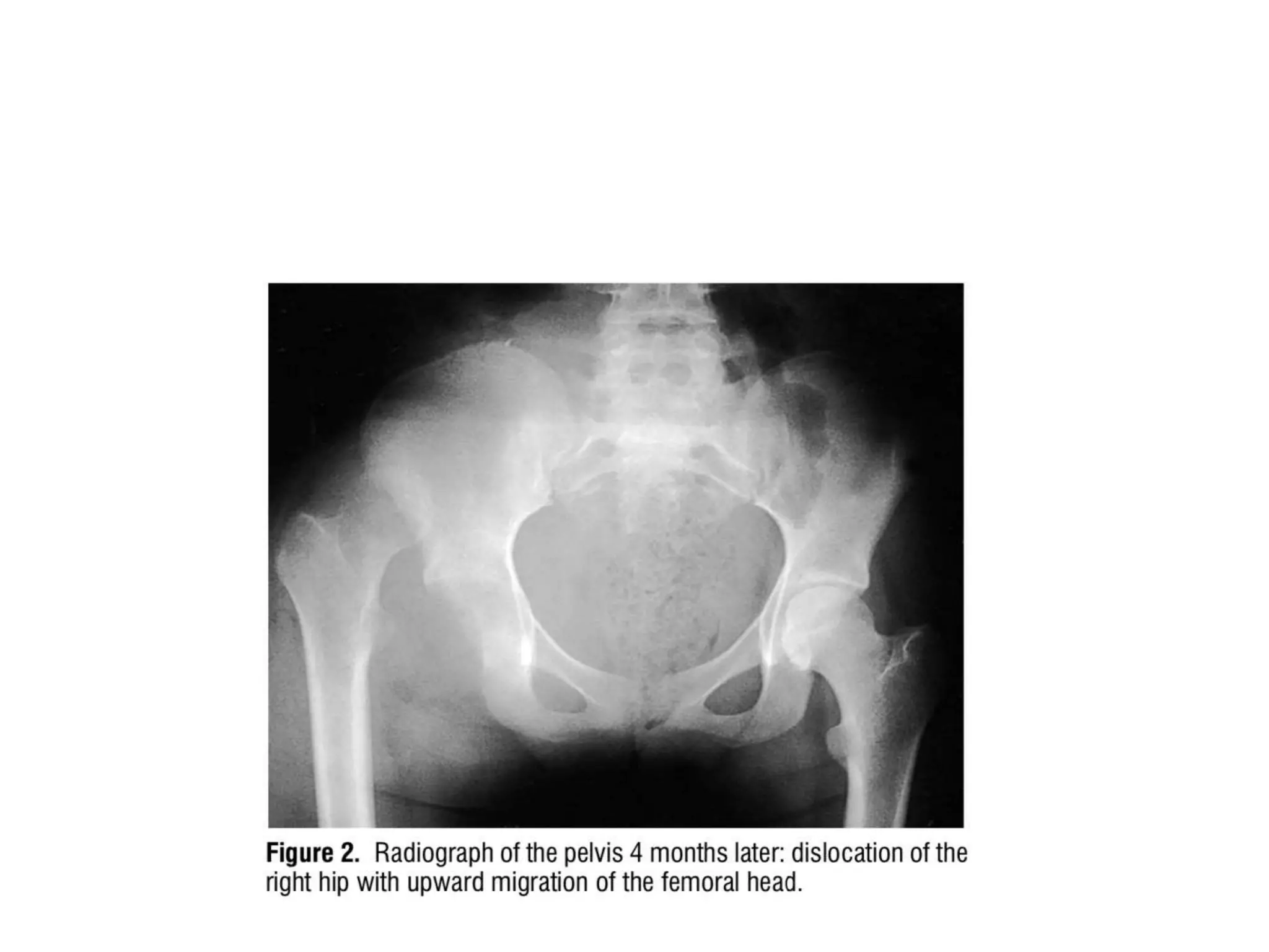 Tuberculosis of Hip joint and Management-30-06-2021.pptx
