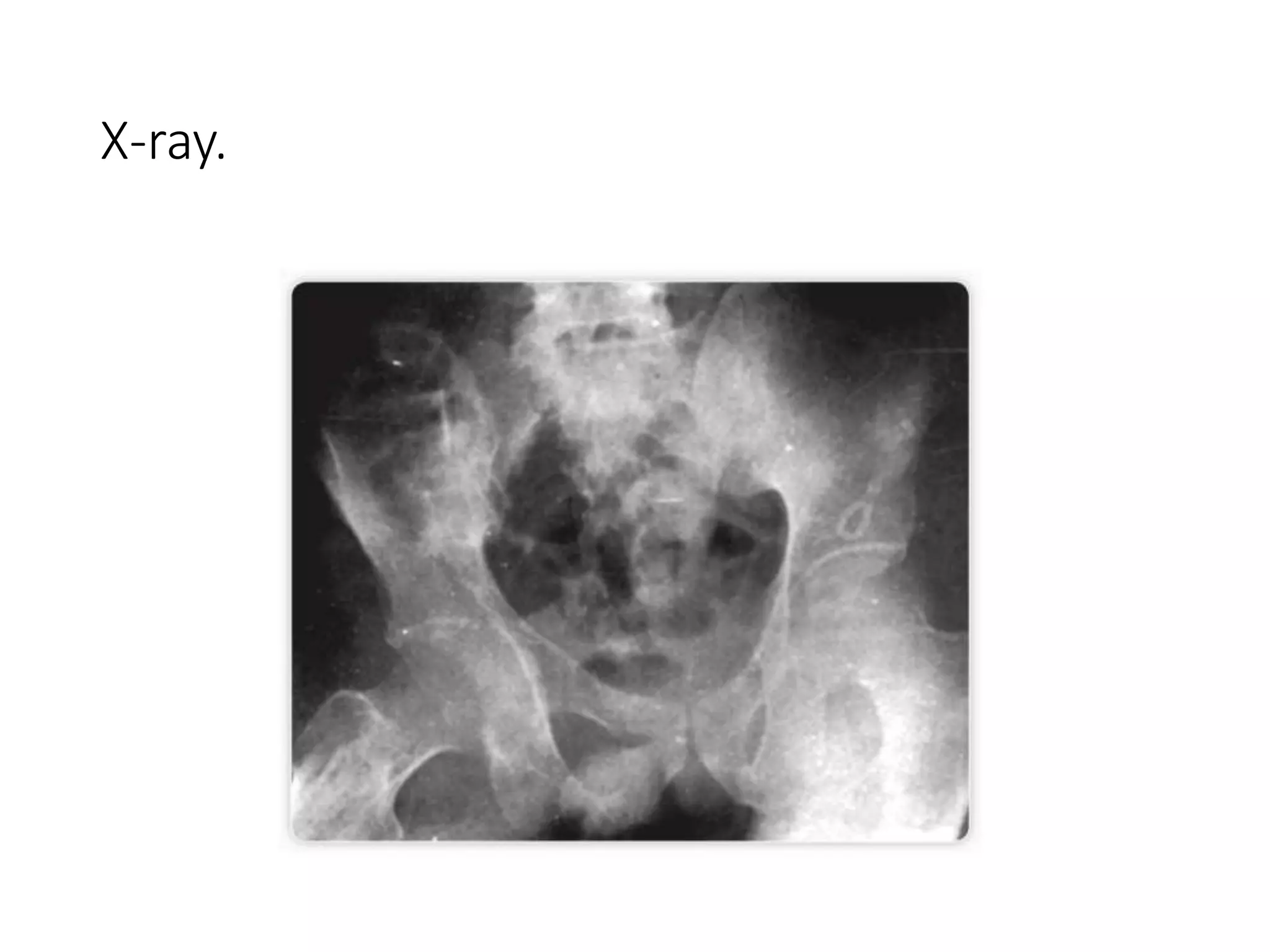 Tuberculosis of Hip joint and Management-30-06-2021.pptx