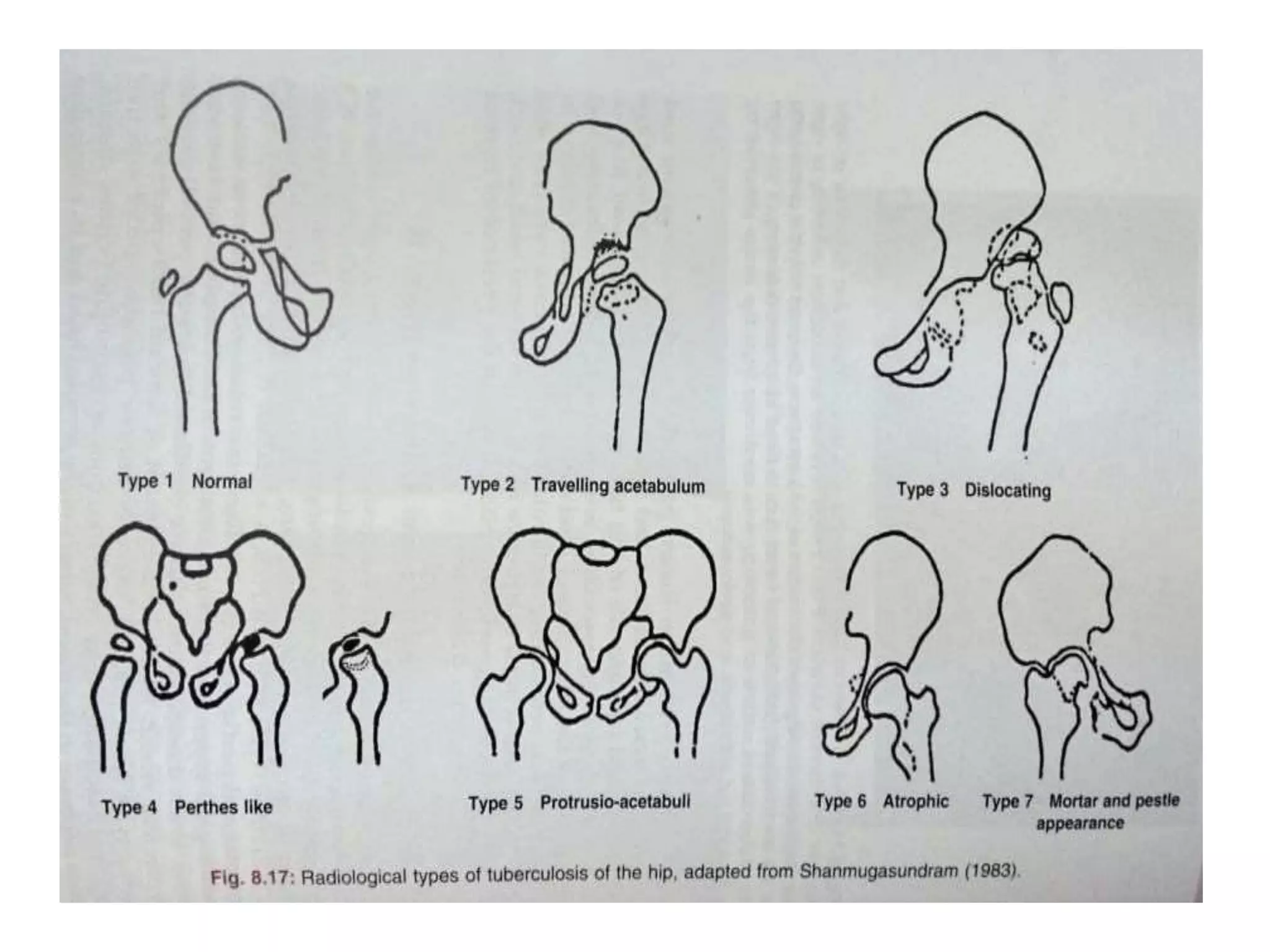 Tuberculosis of Hip joint and Management-30-06-2021.pptx