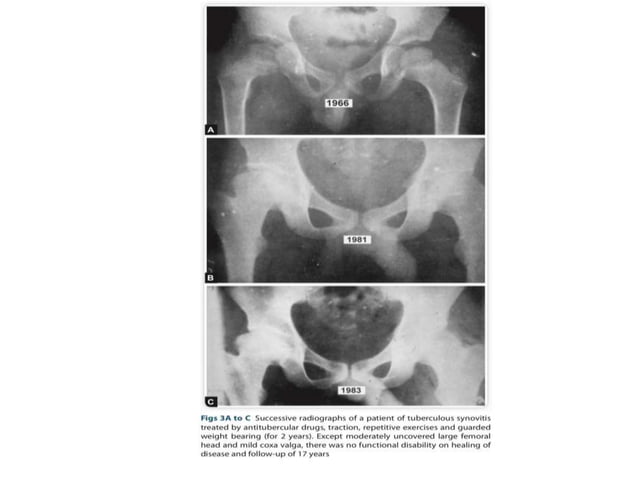 Tuberculosis of Hip joint and Management-30-06-2021.pptx