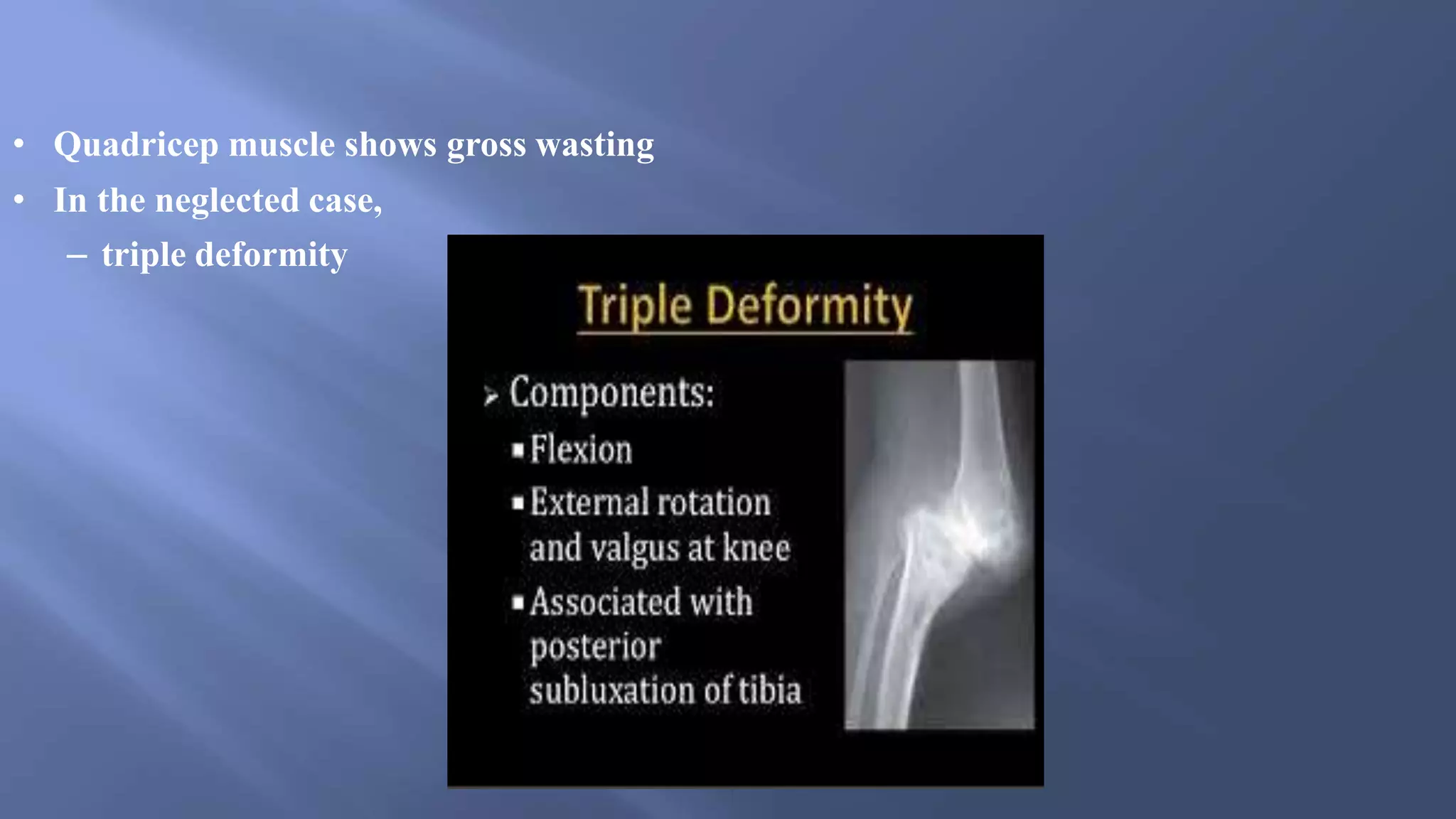 Tuberculosis of knee by dr ashutosh | PPTX