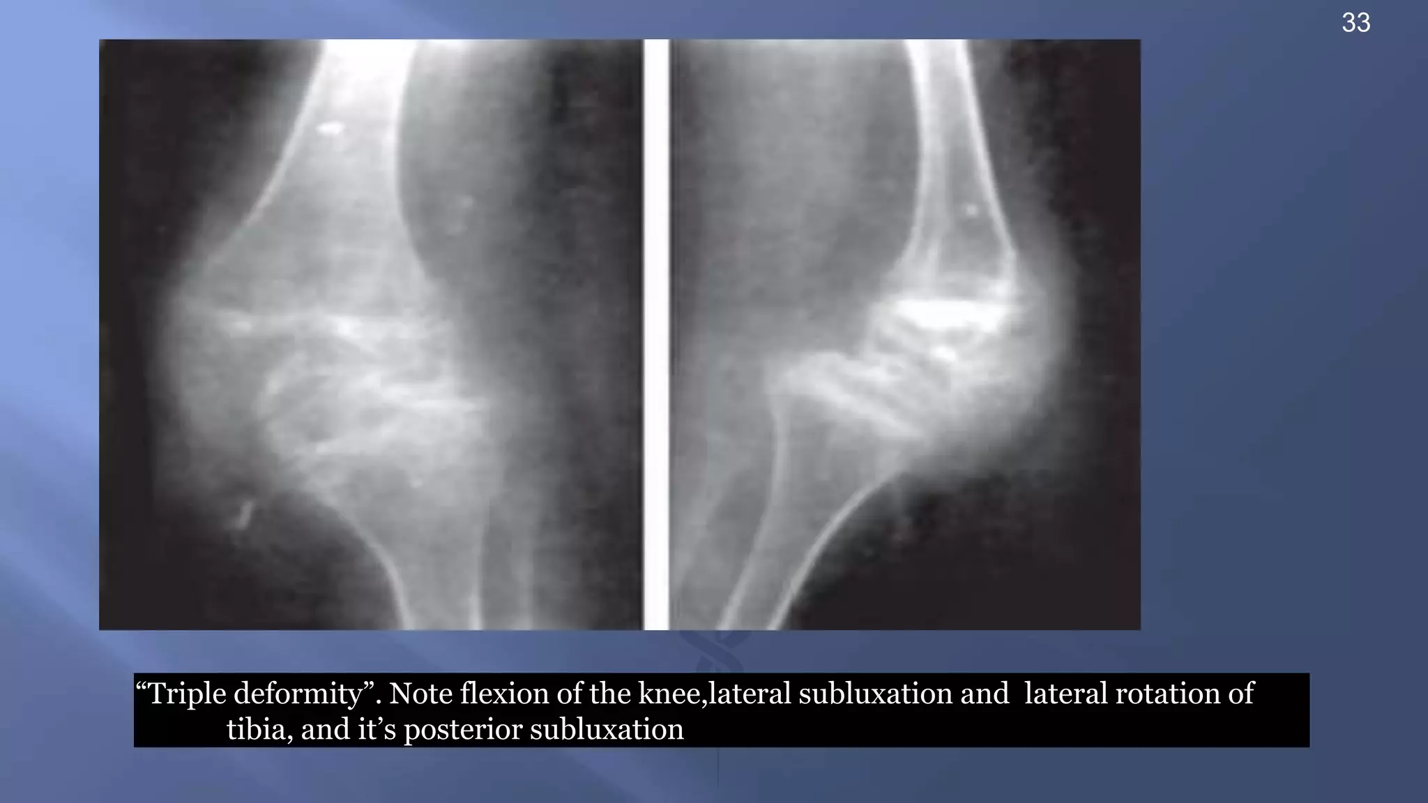 Tuberculosis of knee by dr ashutosh | PPTX