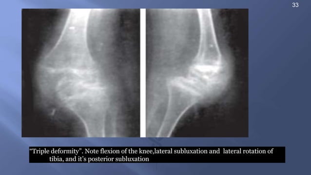 Tuberculosis of knee by dr ashutosh | PPTX | Bone and Joint Conditions ...