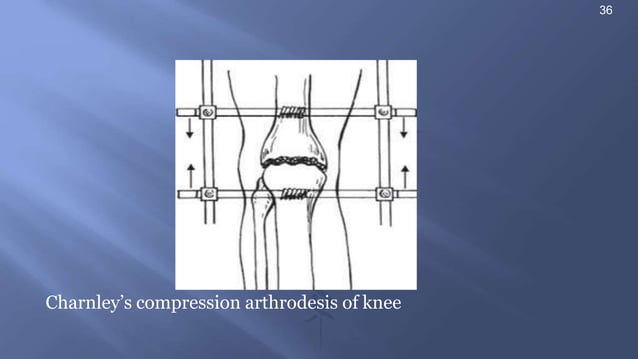Tuberculosis of knee by dr ashutosh | PPTX | Bone and Joint Conditions ...