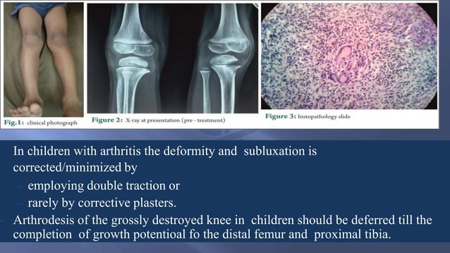 Tuberculosis of knee by dr ashutosh | PPTX | Bone and Joint Conditions ...