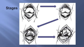 Tuberculosis of knee by dr ashutosh | PPTX