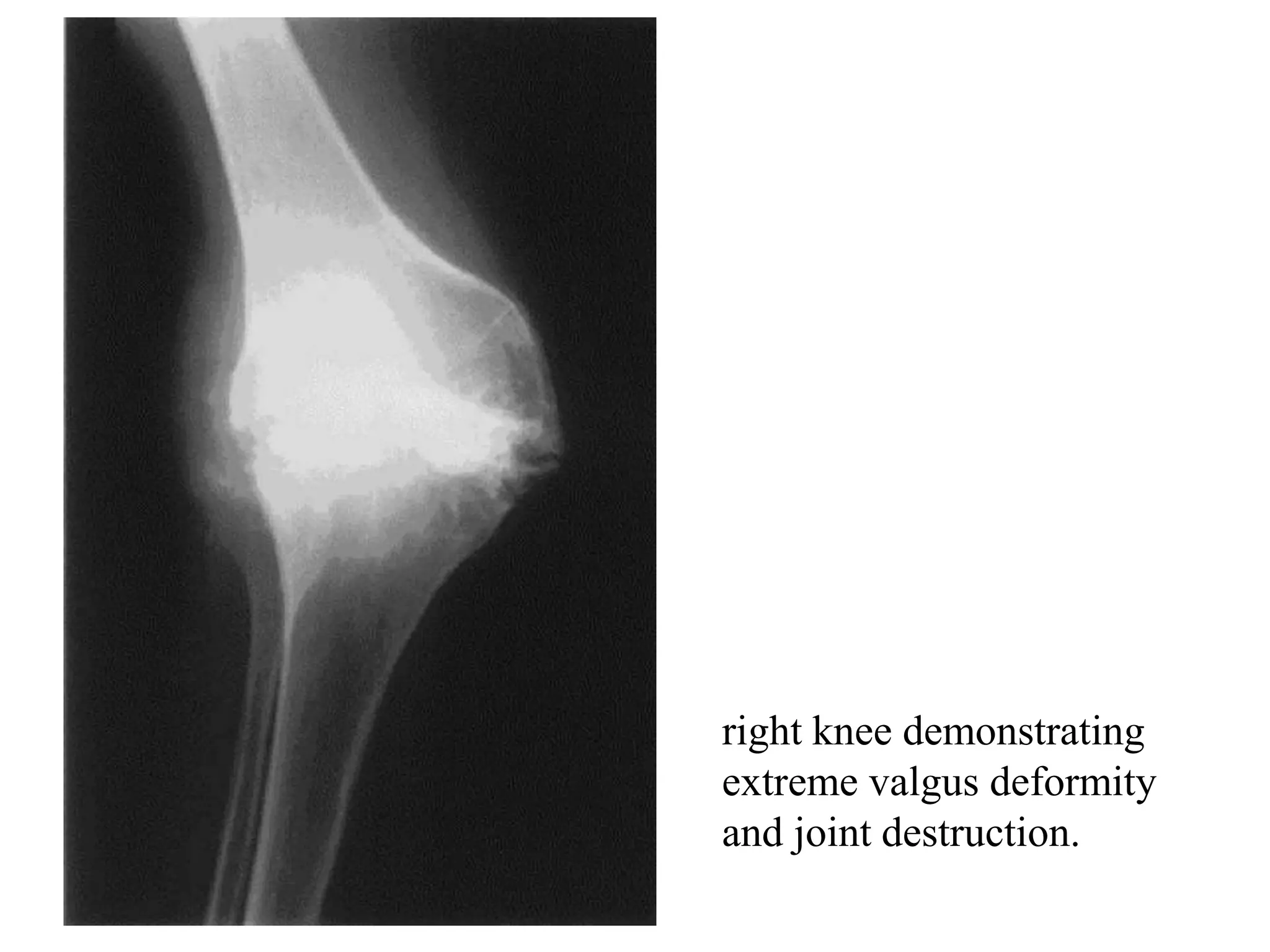 Tuberculosis of knee | PPTX