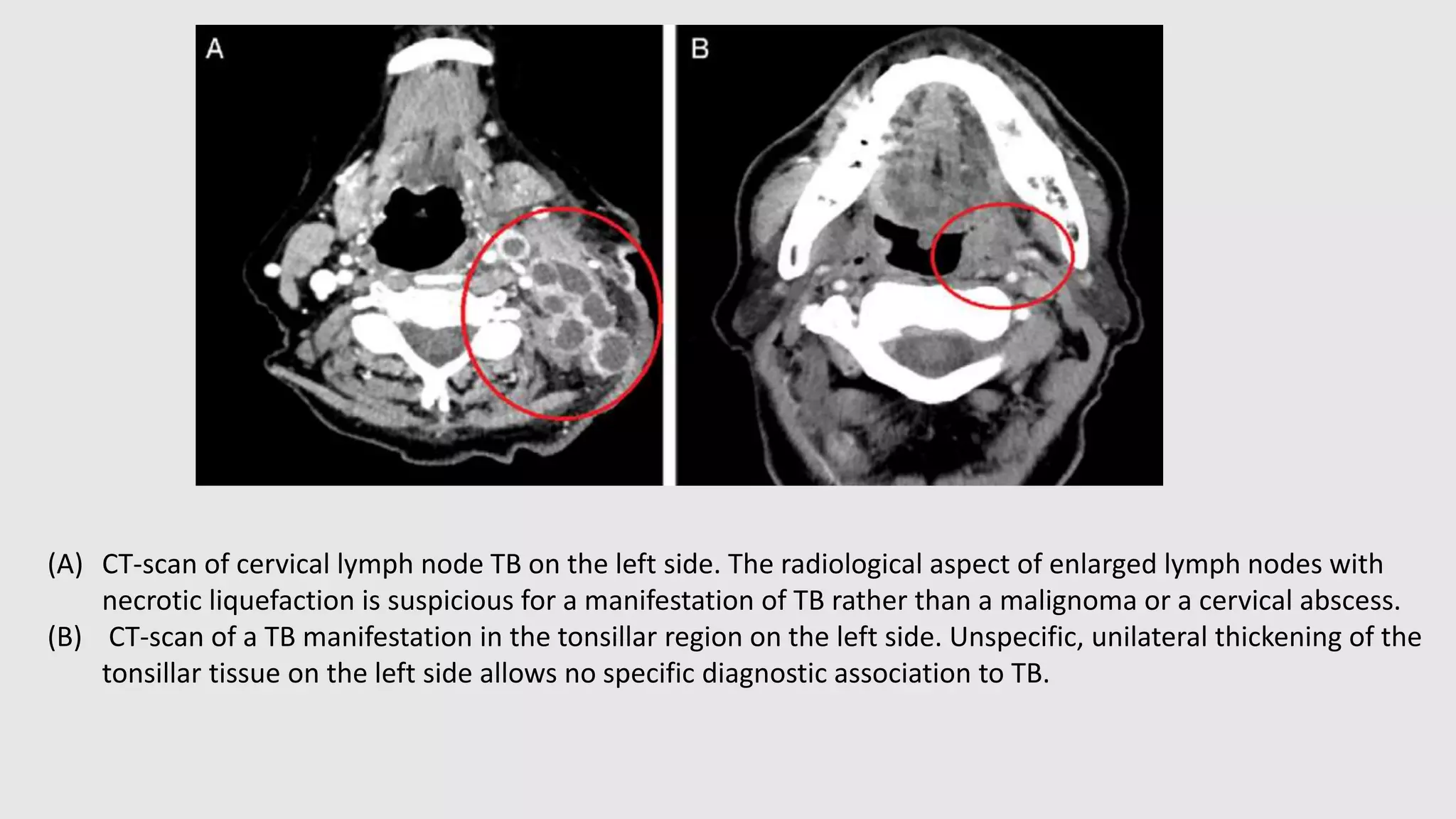 Tuberculosis of peripheral lymph nodes.pptx