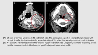 Tuberculosis of peripheral lymph nodes.pptx