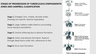 Tuberculosis of peripheral lymph nodes.pptx