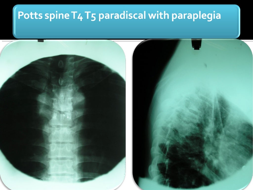 Tuberculosis Of Spine